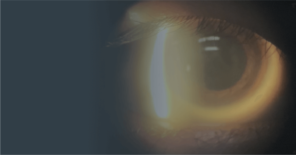 Optometry Case Study on Blurry Vision | Eyecare Plus